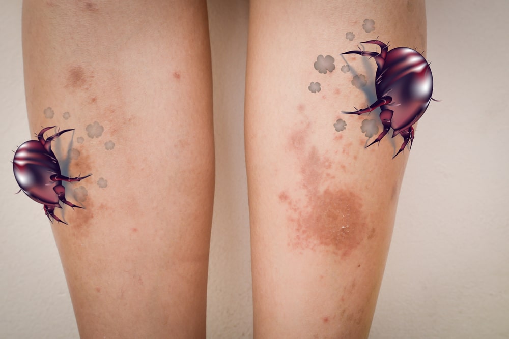 Est-ce que les acariens restent sur la peau