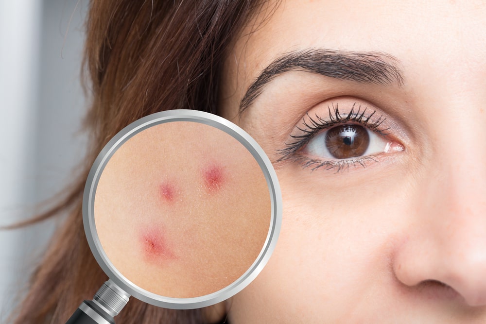 Les symptômes d’une allergie acarien au visage